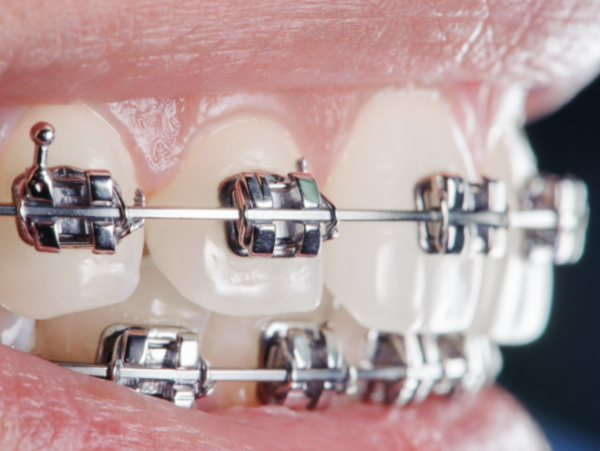 Reasons Why Brackets Fall Off & What to Do | Wonder West Orthodontics