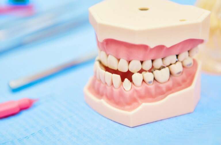 Underbite Treatment Guide | Wonder West Orthodontics